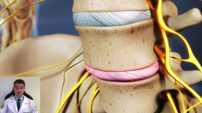 Entendendo a Discopatia Lombar: Causas e Tratamentos | Actualizado ...