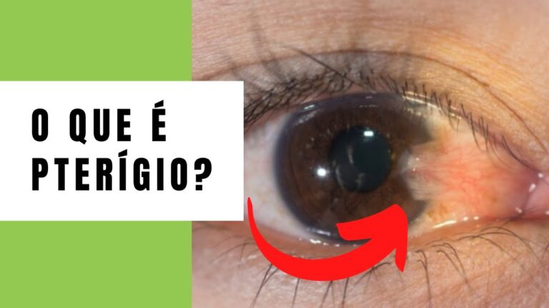 Pterígio nos olhos: causas, sintomas e tratamentos | Actualizado marzo 2026