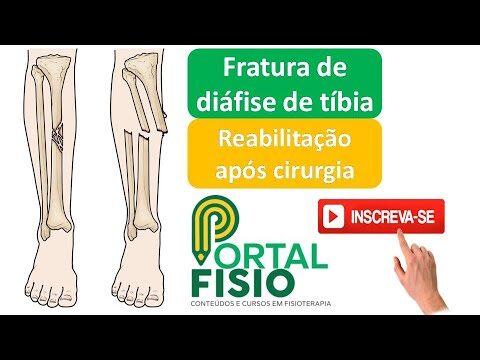 Recuperação após cirurgia de tíbia com haste | Actualizado diciembre 2025