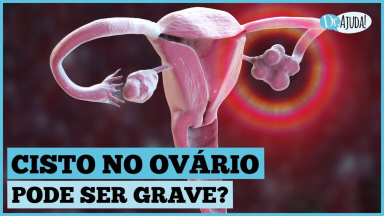 Guia Completo sobre Cisto Ovariano Simples: Causas, Sintomas e ...