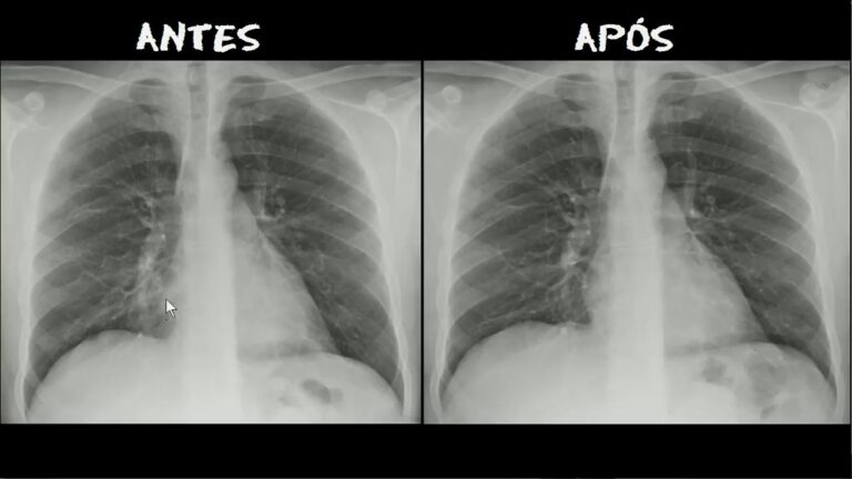 Tratamento eficaz para pneumonia com RX de pulmão | Actualizado ...