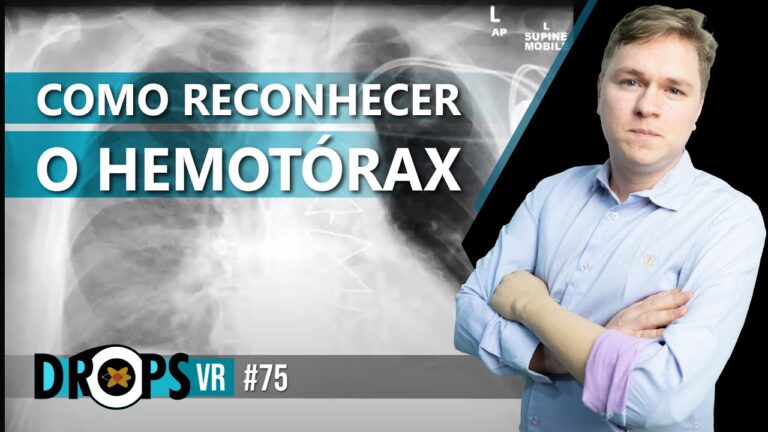 Tratamento Eficaz do Hemotórax: Abordagens e Estratégias | Actualizado ...