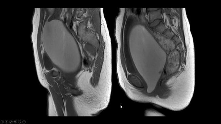 Desmistificando o Himem Imperfurado | Actualizado abril 2025