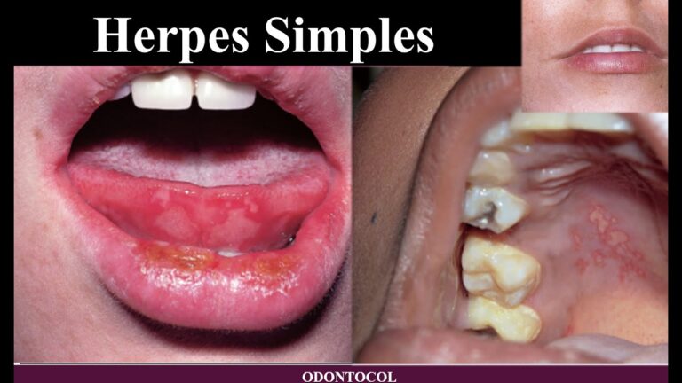 Herpes no Palato: Causas, Sintomas e Tratamentos | Actualizado octubre 2025