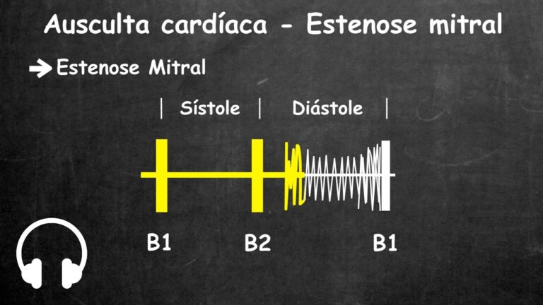 Sopro da Estenose Mitral: Diagnóstico e Tratamento | Actualizado ...