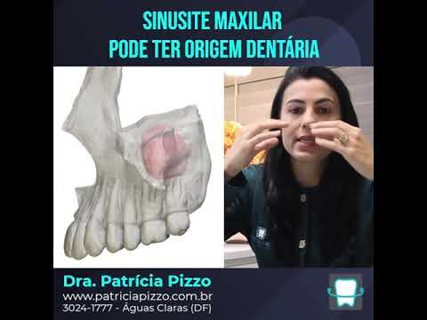 Entendendo a Sinusite Maxilar Aguda: Causas e Tratamentos Eficazes ...