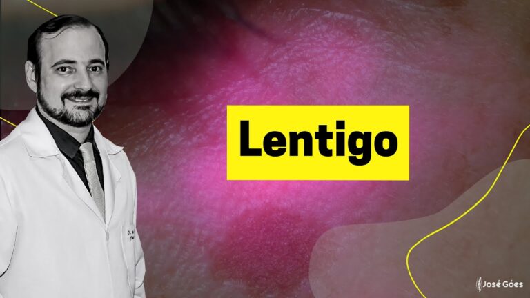 Lentigo Simples: Causas, Sintomas e Tratamentos | Actualizado diciembre ...