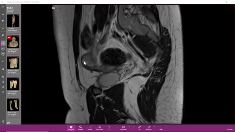 Síndrome de Rokitansky: Fotos e Informações Essenciais | Actualizado ...