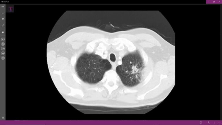 Síndrome de Pancoast: Causas, Sintomas e Tratamentos | Actualizado ...