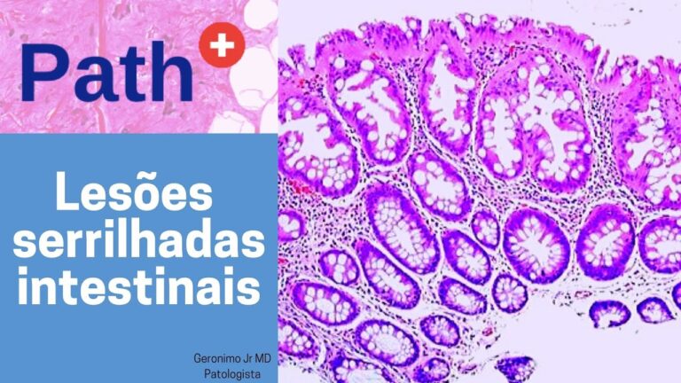 Lesão Serrilhada Sessil: O Que Você Precisa Saber | Actualizado ...