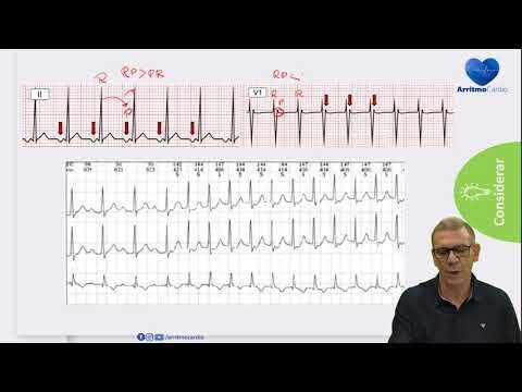 Taqui Supra ECG: Entendendo o Diagnóstico e Tratamento | Actualizado ...