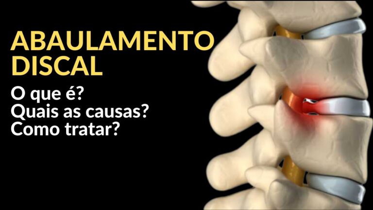Entendendo o Abaulamento Discal em C3, C4, C5 e C6 | Actualizado ...