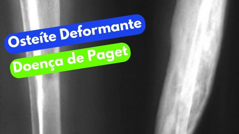 Osteíte Deformante: Entenda o Que É e Seus Efeitos | Actualizado ...