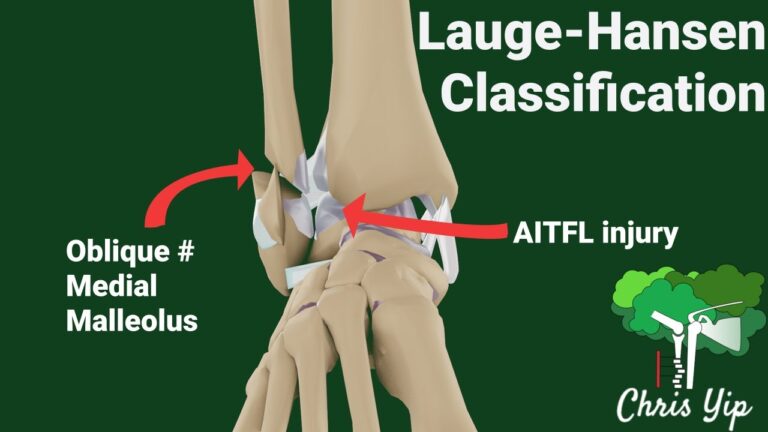 Classificação Lauge Hansen: Entendendo as Fraturas de Tornozelo ...