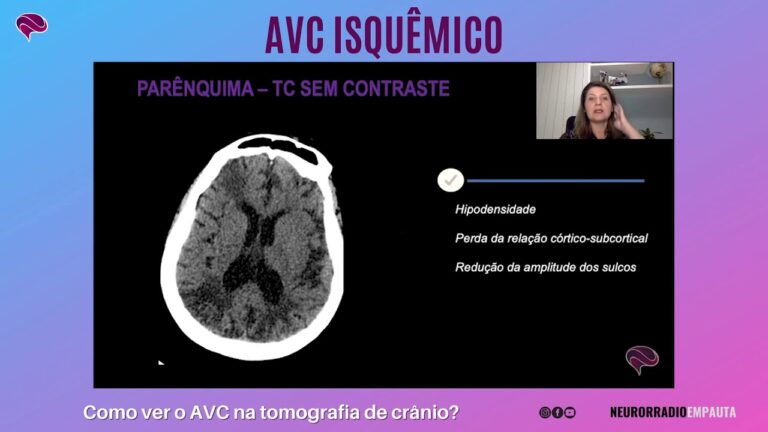 Tomografia na Avaliação do AVC Isquêmico | Actualizado diciembre 2025