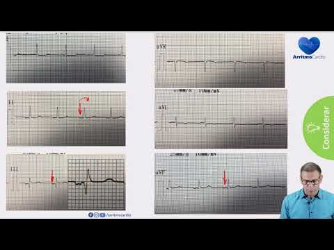 Análise Eficiente da Onda Delta no ECG | Actualizado septiembre 2025