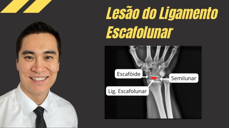 Tratamento Eficaz para Ligamento do Pulso Rompido | Actualizado marzo 2026